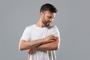 Hoe ziet huidschimmel eruit? - Huisarts.nl - oorzaken, behandelingen en ...